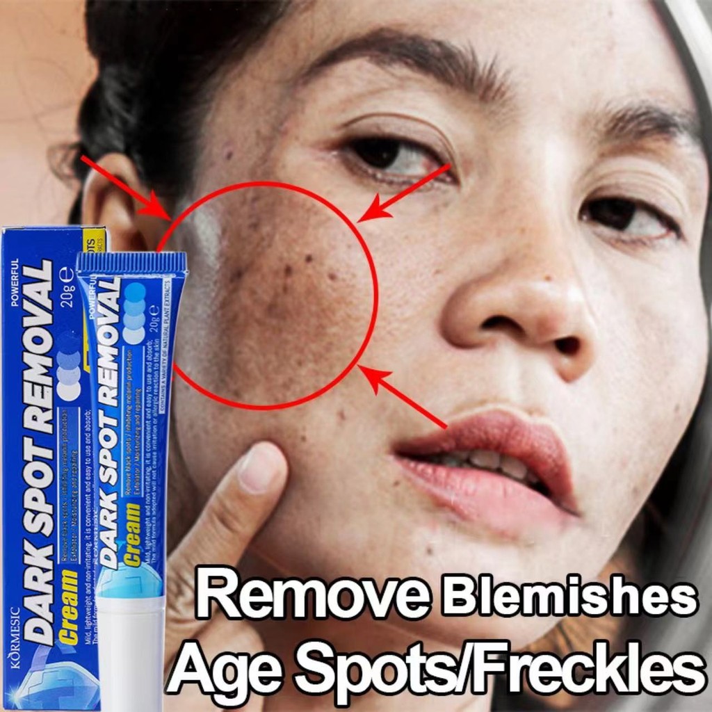 Melasma Cream Pekas Remover Original Collagen Freckles Remover Cream ...