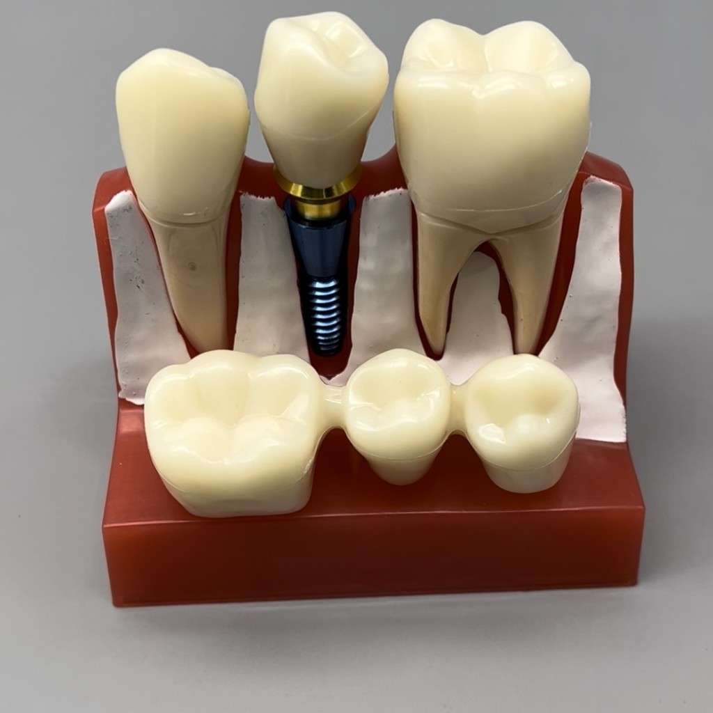 Dental 4 Times Implant Teeth Practice Model Dental Teach Implant ...