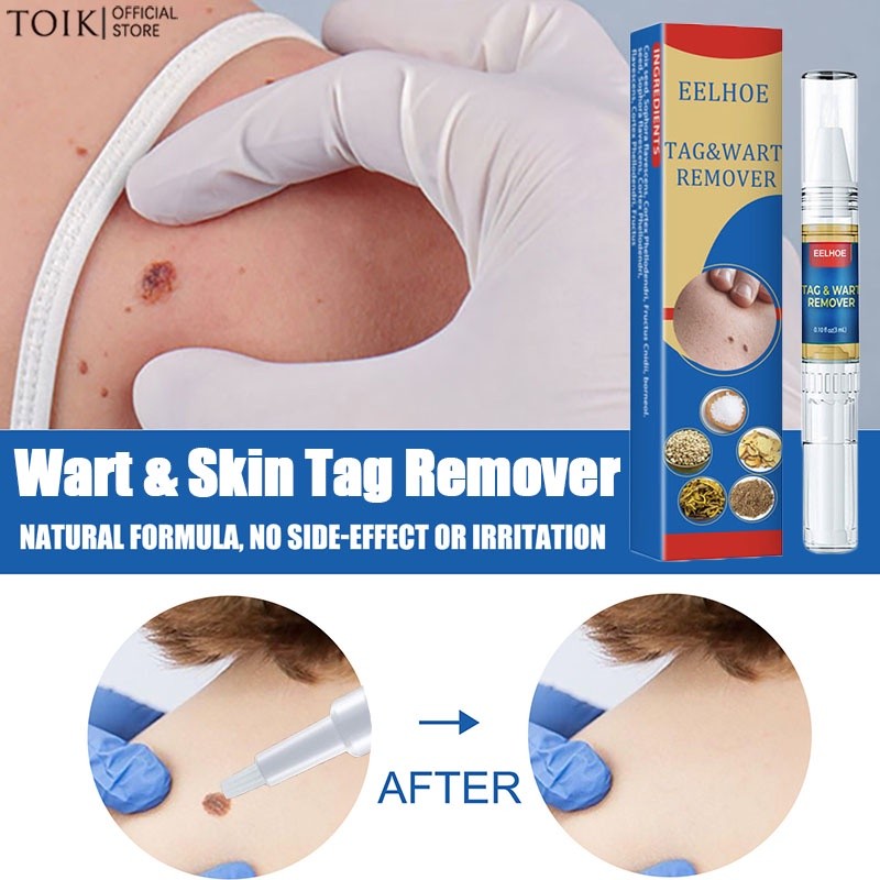 EELHOE Warts & Skin Tag Remover Pen Original Warts Remover Cream Wartz ...