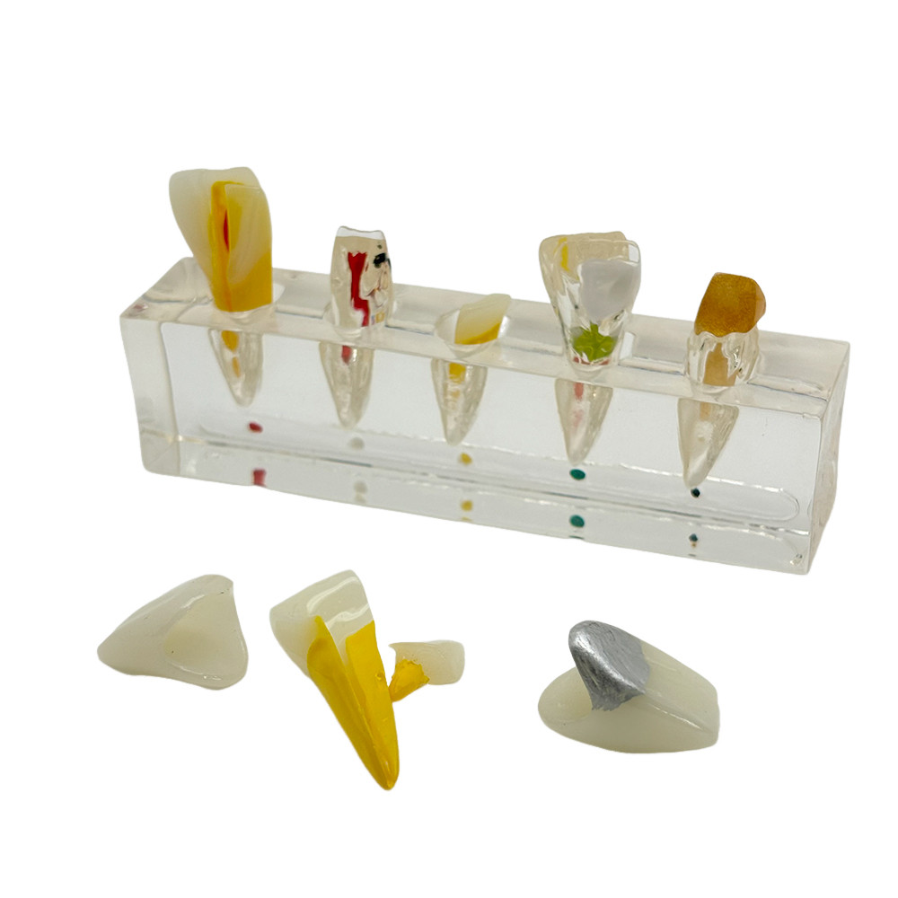 Dental Models Endodontic Pathological Anterior Front Labial Teaching ...