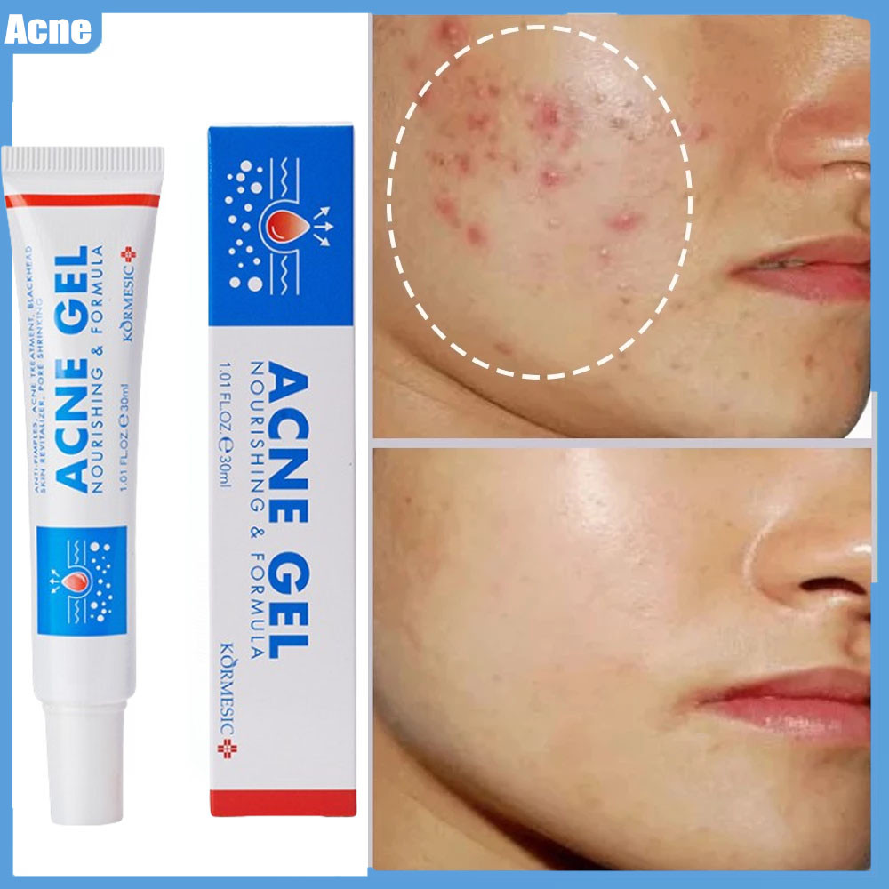 Acne Treatment Cream Facial Essence Anti Acne Cream Skin Care Whitening ...