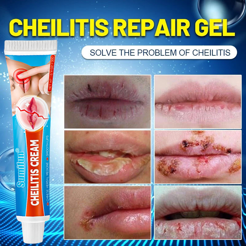 Cold Sores Lip Cheilitis Treatments Cream Herpes Antibacterials Ointment Chapped Lips Wrinkles ...