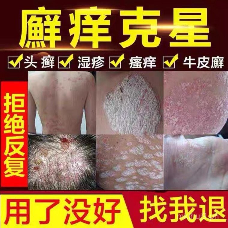 Haoyan Yunnan Herbal Ringworm Spray for Tinea Capitis, Psoriasis ...
