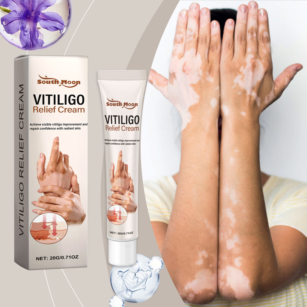 【in stock】South Moon Vitiligo Relief Cream White Spot Removal Cream ...