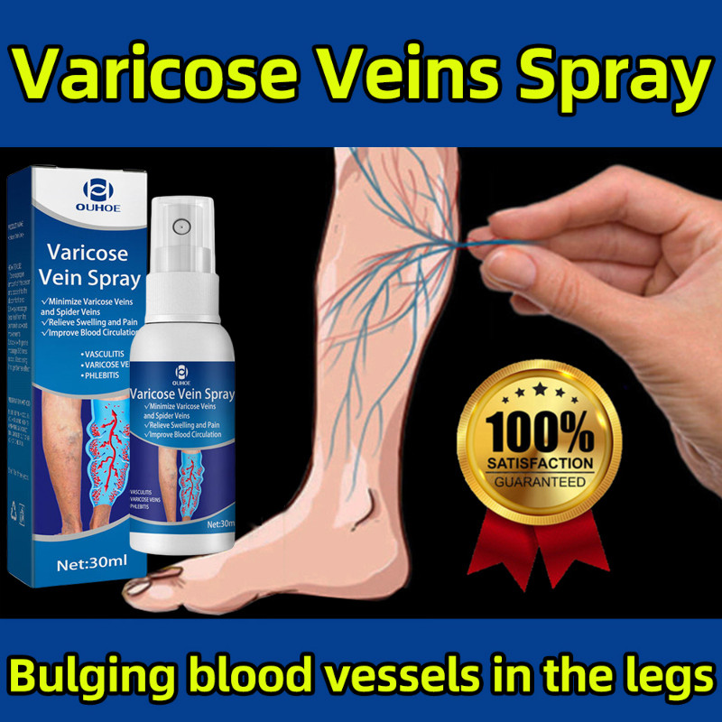 Effective Varicose Vein Treatment Spray Spider Varicose Vein Pain ...
