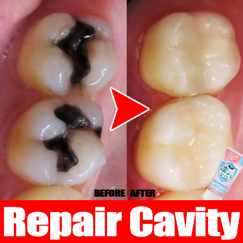 Anti-caries toothpaste recommended, used by Filipino families | Shopee ...