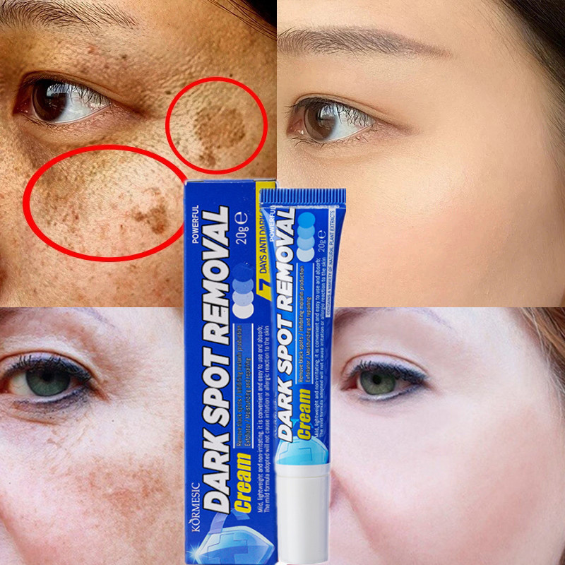 KORMESIC Dark Spot Removal Cream Lighten Melanin Improve Dullness ...
