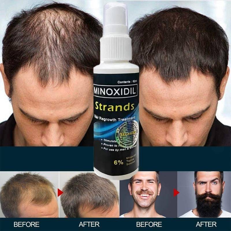 Strands Minoxidil 6% Topical Solution for Men and Women Hair Grower 60m ...