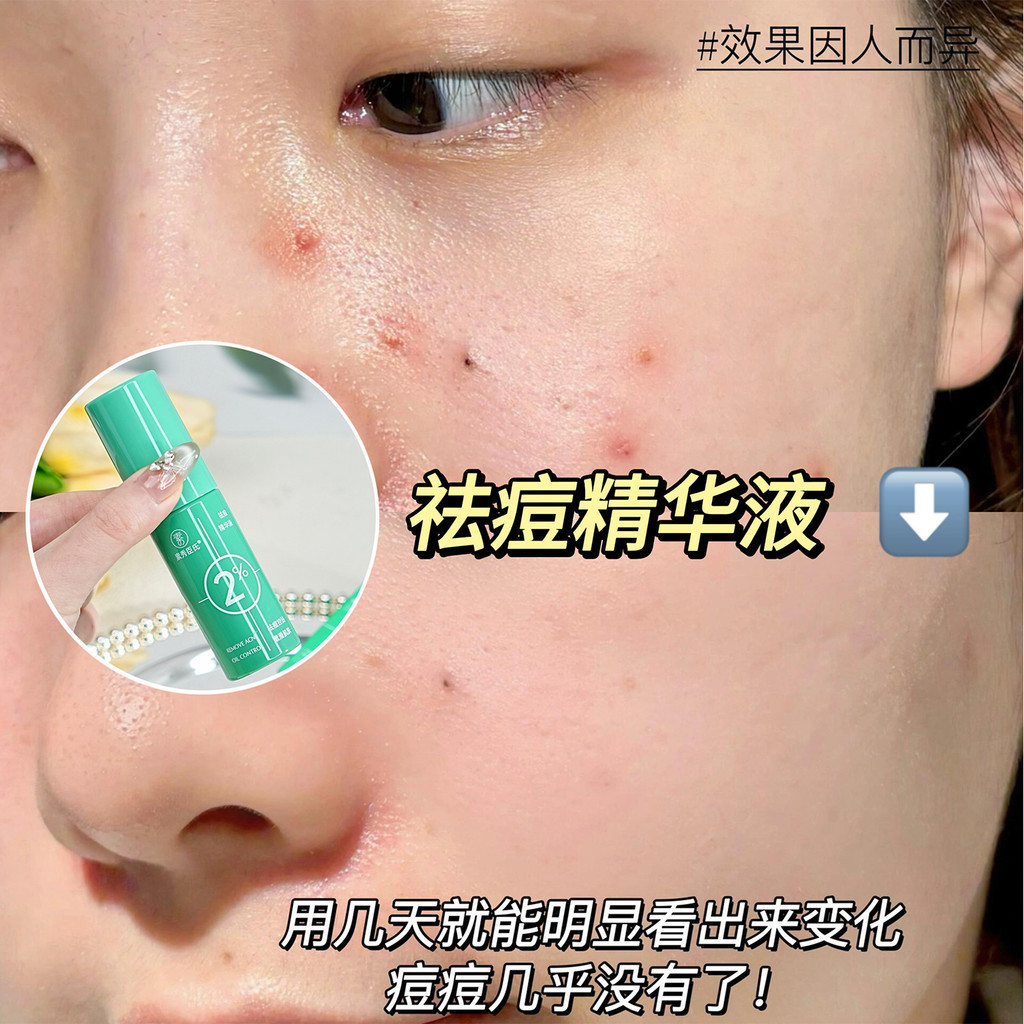 Acne Remove Essence 15ml Improve Closed Mouth Acne Reduce Pimple Marks ...