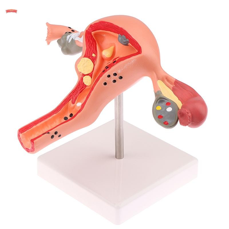 YESC 1Pcs Props Model Pathoical Uterus Ovary Anatomical Model Anatomy ...
