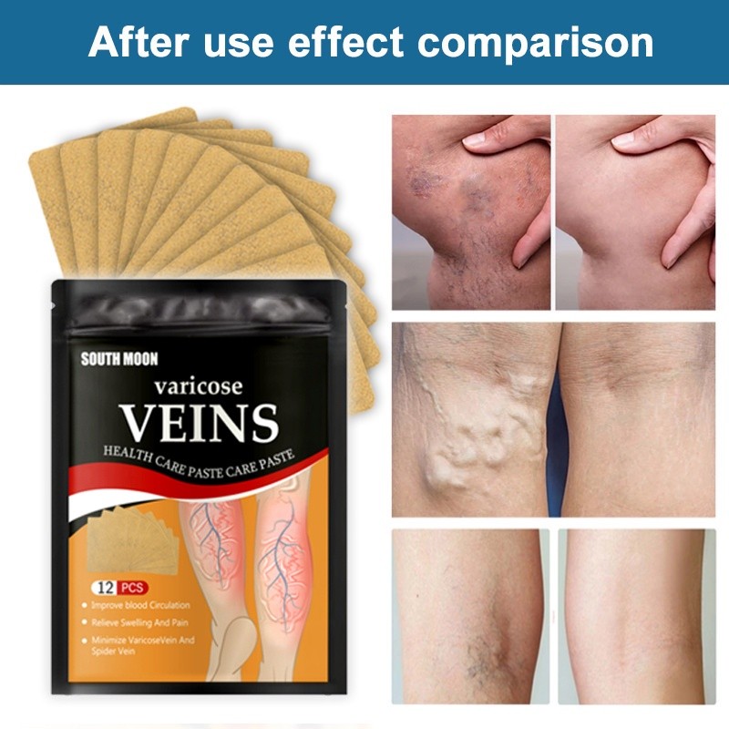 AE Varicose Veins Plaster 12pcs Patch Pain Relief Relievers Knee ...