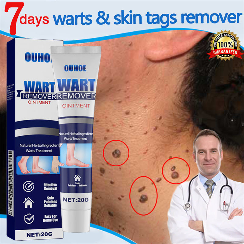Warts Removal Cream Mole Skin Tags And Warts Remover Ointment Painless ...