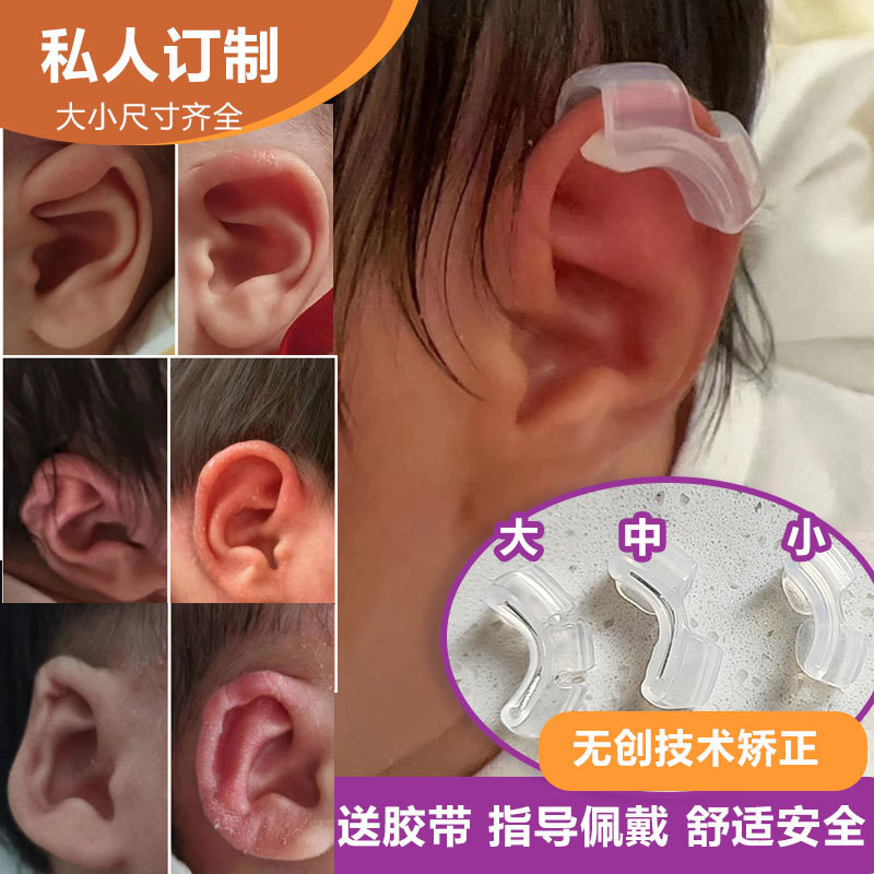 Auricle Brace Baby Ear Correction Corrector Baby Ear Deformity Newborn ...