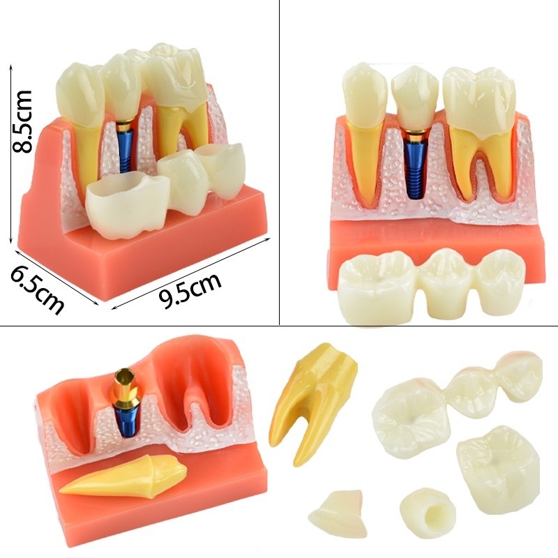Dental Teach Implant Analysis Crown Bridge Removable Model Dental ...