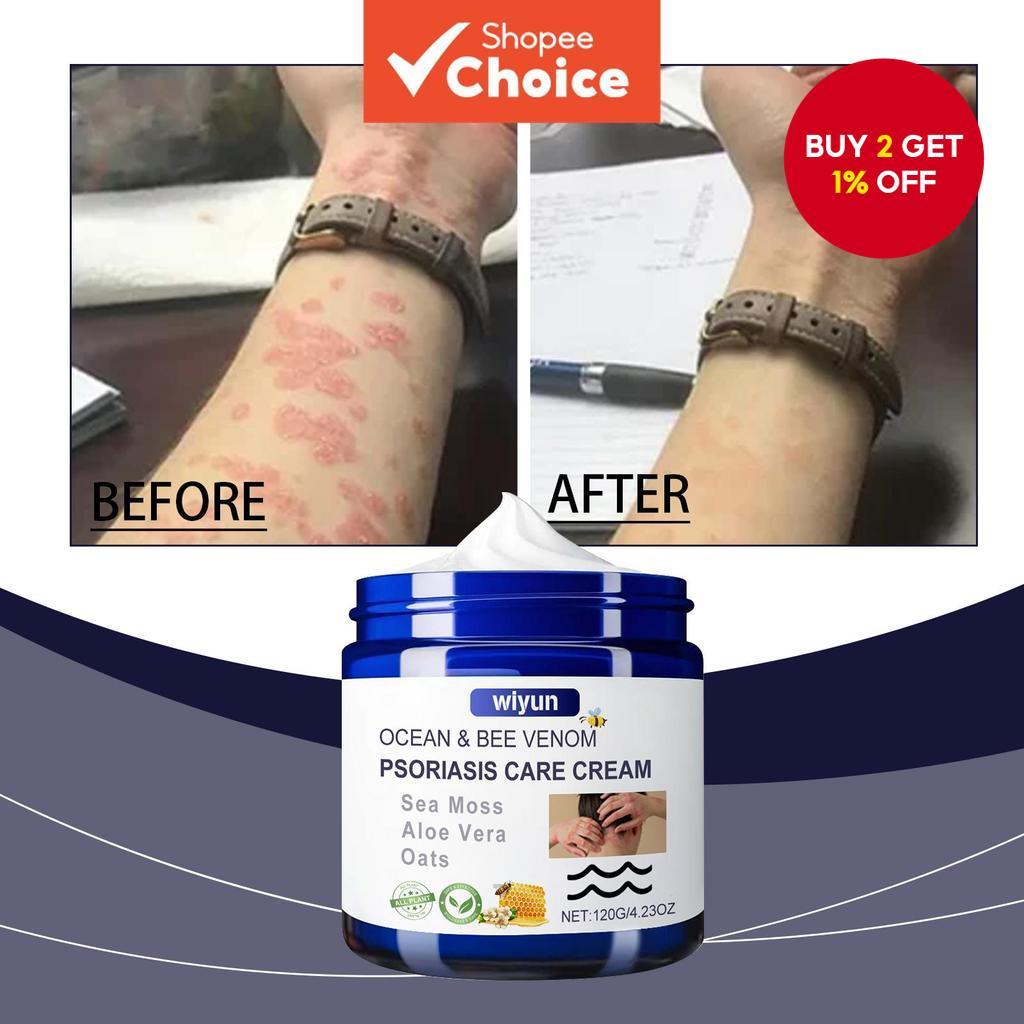 Bee Venom Psoriasis Cream for Eczema and Dermatitis Skin Care | Shopee ...
