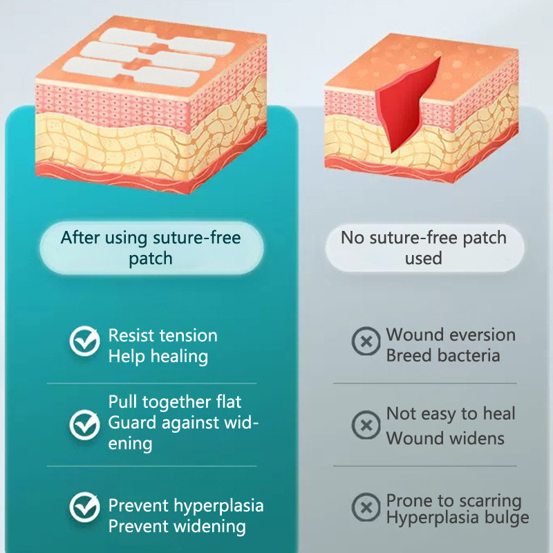 BBS Bless 1/3/10/50 Patches Butterfly Closure Bandage Strips Adhesive ...