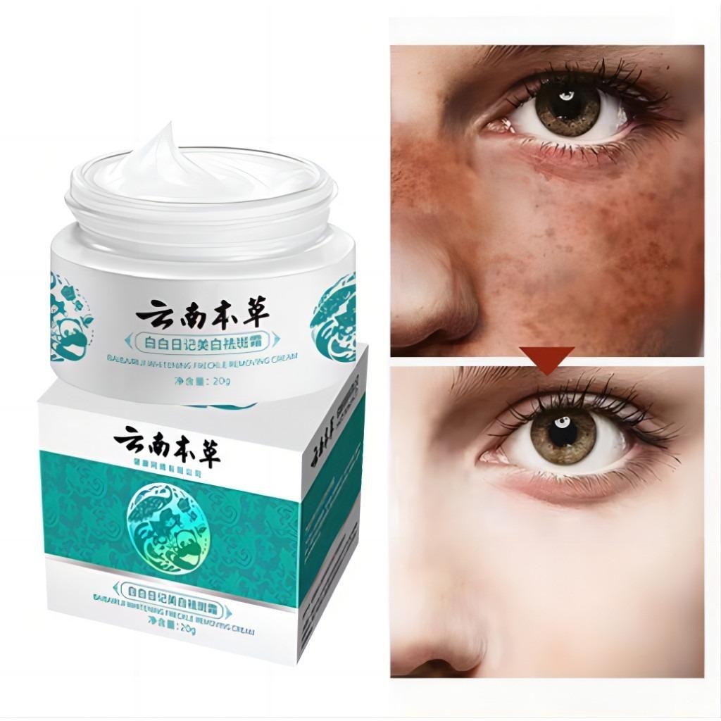 Melasma Cream PekaMelasma Cream Pekas Remover Yunnan Herbal Effective ...