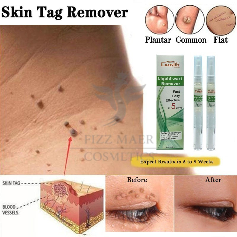 Skin Tag Remover Pen Natural Health Wart Skin Tag Foot Corn Warts ...