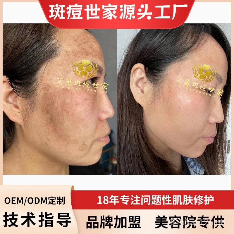 No Embarrassment Period Spot Removal Combination Whitening Brightening ...