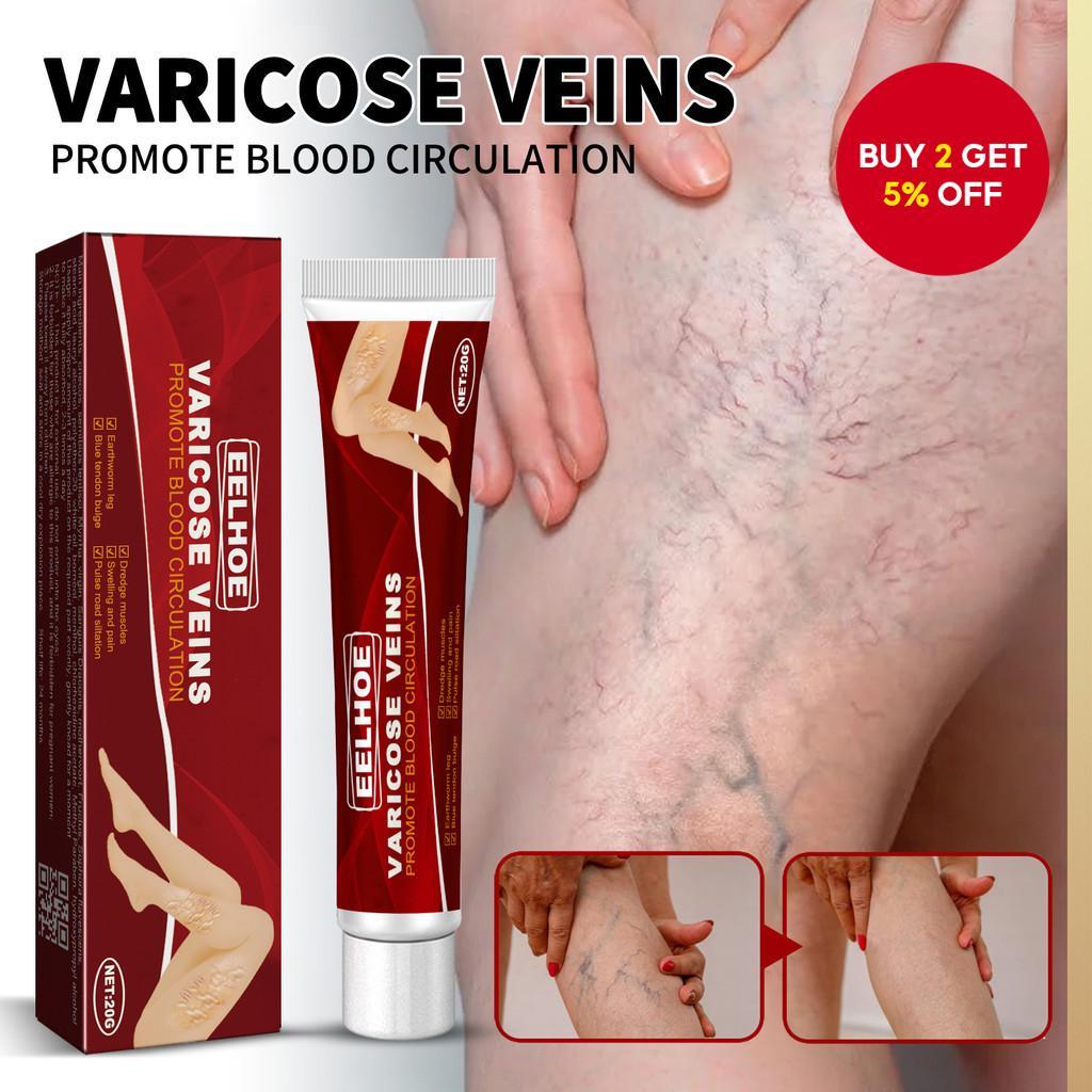 Varicose Vein Cream Venous Massage Ointment Earthworm Leg Inflammation ...