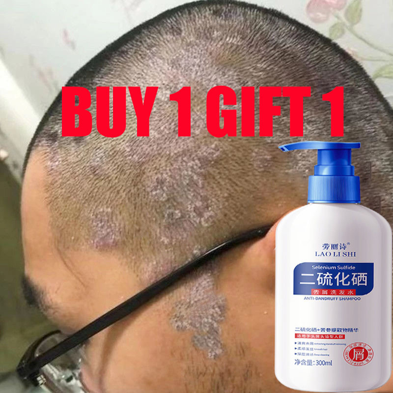 Psoriasis Shampoo Oil Control Anti Dandruff Shampoo Psoriasis for Scalp Itching Hair Treatment ...