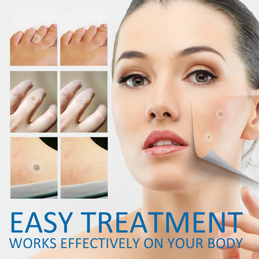 West Month Skin Tag Remover Patch Wart Acne Stickers Invisible Warts ...