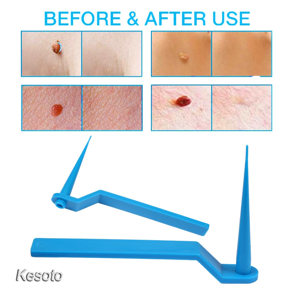 Skin Tag Removal Kit Kill Skin Mole Wart Remover Micro Band Remove Skin ...
