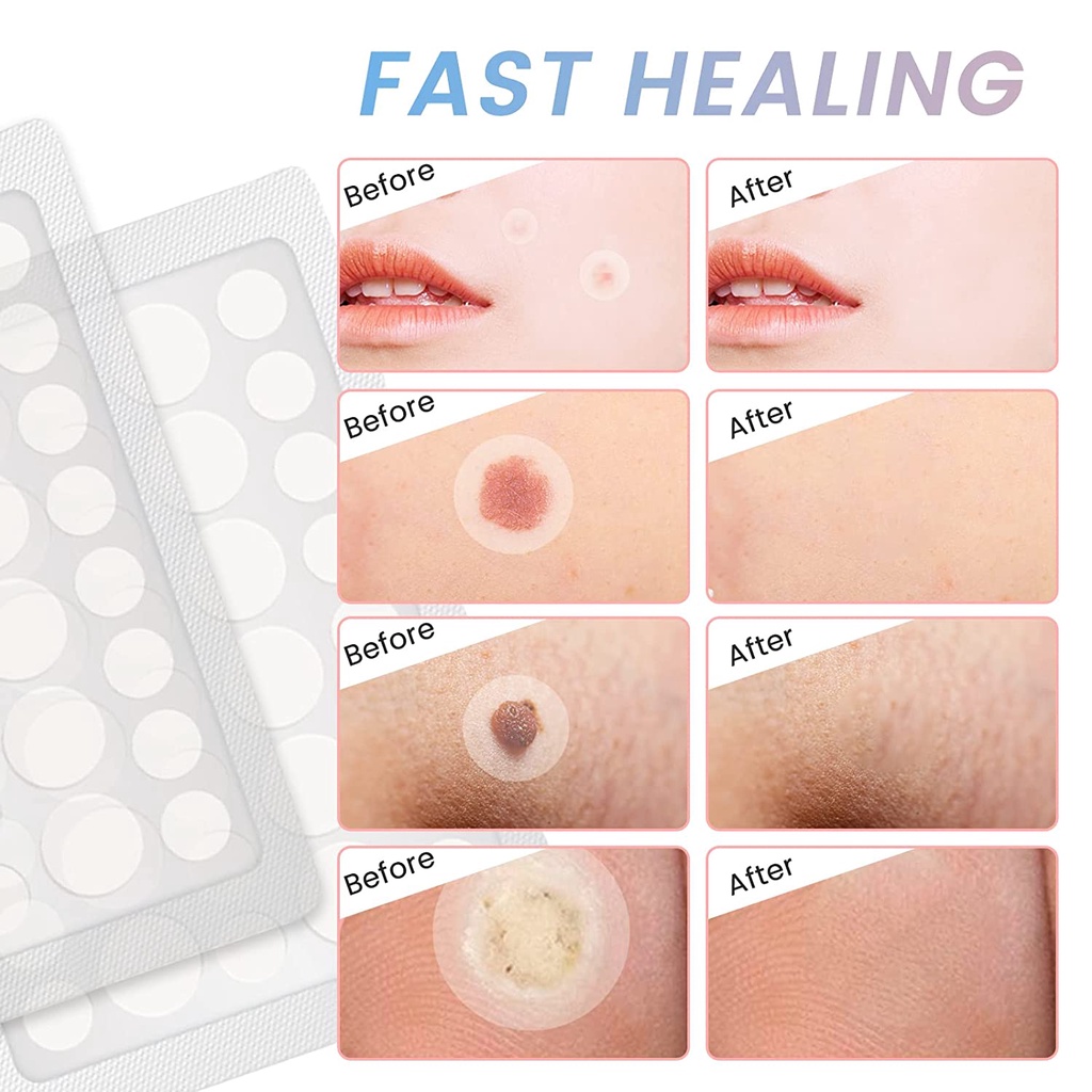 72PCS Acne Pimple Repair Patch Waterproof Acne Patch Blemish Treatment ...