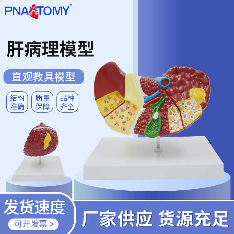 Dissection Color Separation Liver Damage Medical Teaching Aids 1 Human ...