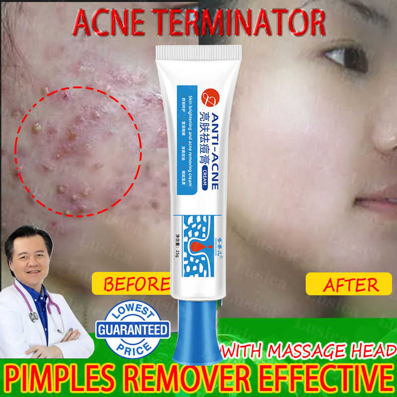 Orignal Remove Pimples Anti-Acne Quickly Fades Marks Repairs Pits ...