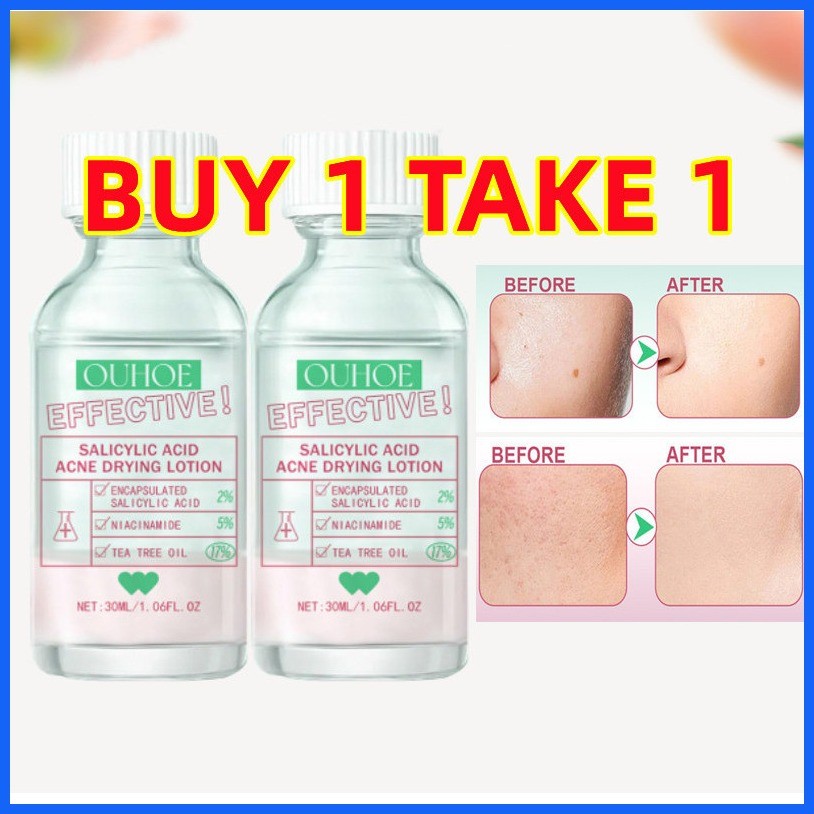 【BUY 1 TAKE 1】Pimple Warrior Salicylic Acid Acne Drying Lotion With ...