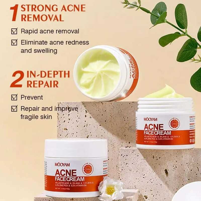 Acne Cream 100G For Removing Acne And Fading Acne Scars Moisturizing ...