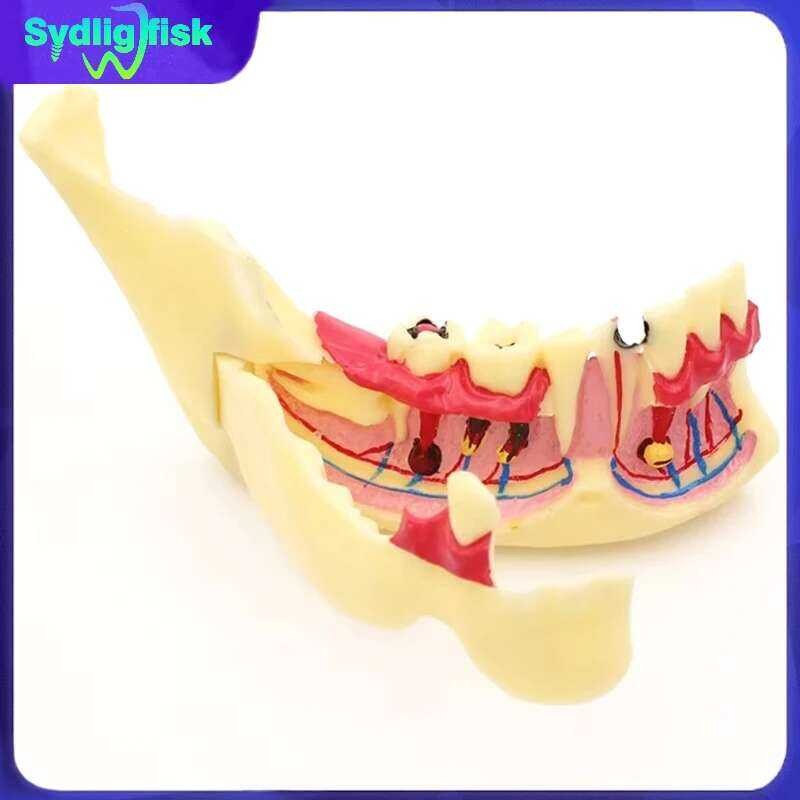 Dental Enntic Treatment Model Mandible Tissue Anatomical Model Anatomy ...