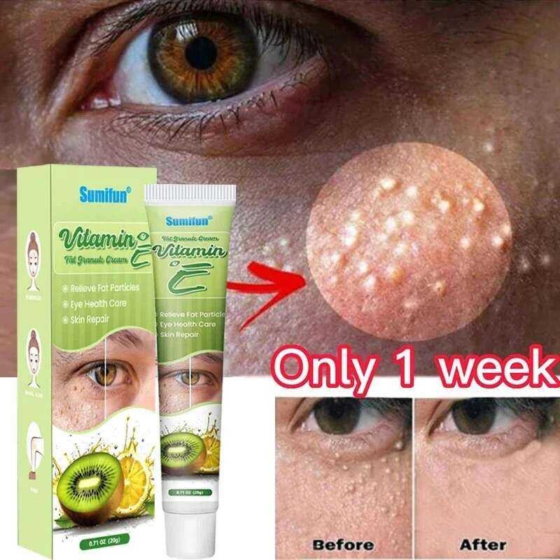 Fat Granules Remover Eye Cream Effective Remove Fat Granules Puffiness ...