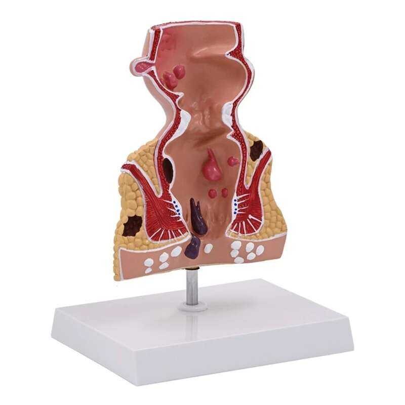 For Lab School Pathologies Of Rectum Human Anatomy 1 Model Medicals ...