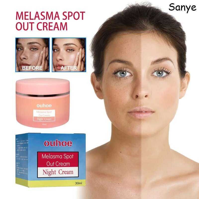 Melasma Remover Cream Removal Dark Pigment Brighten Cream Face Fade ...