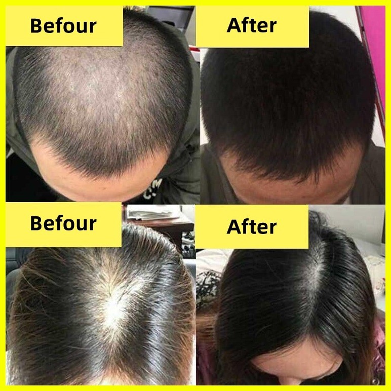 AZLA Ginger Hair Shampoo/Conditioner Anti Hair Loss Oil Control Anti ...