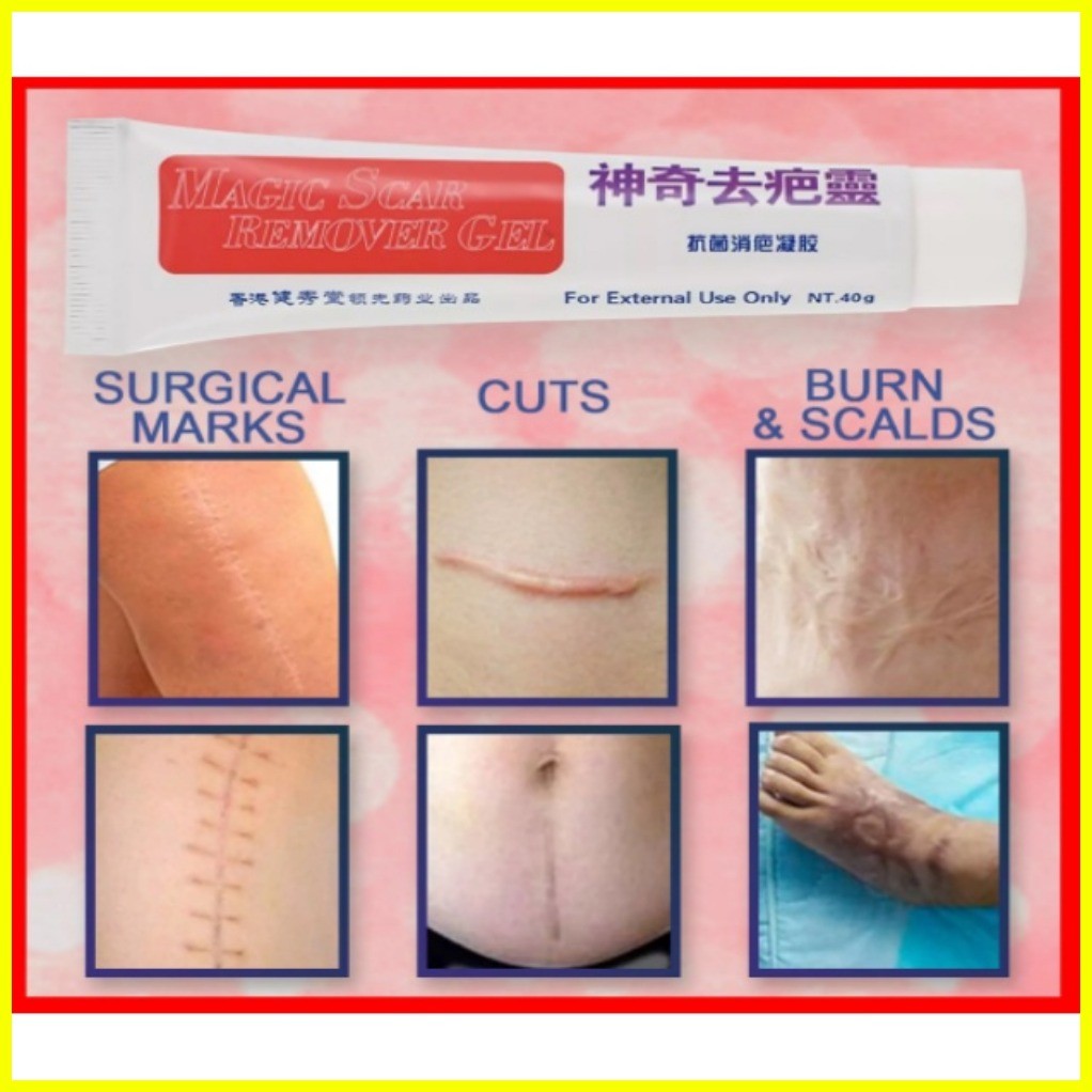 Effective Magic Scar Remover Gel Anti-Scar Cream For Acne And Pimples ...