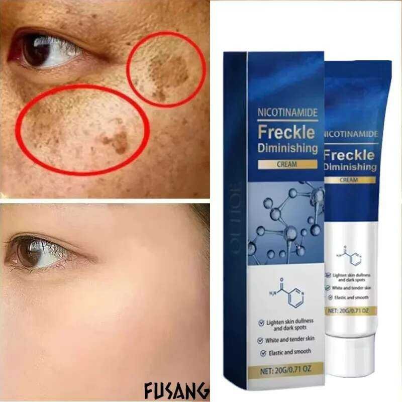 Chloasma Removal Cream Brightening Fade Dull Emulsion Remove Melasma ...