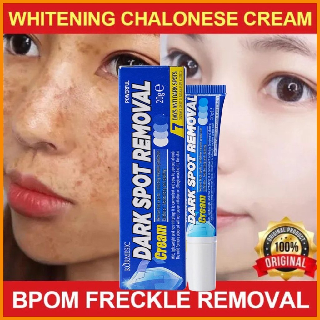Melasma Cream Collagen Japan Pekas Remover Cream Original & Freckles ...