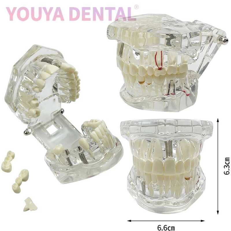 Dental Transparent Disease Tooth Model Typodont Implant With Removable ...