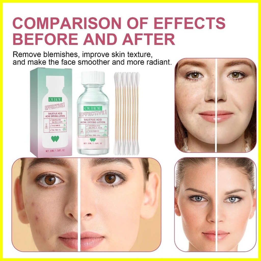 Barenbliss BNB Pimple Warrior Salicylic Acid Acne Drying Lotion Triple ...