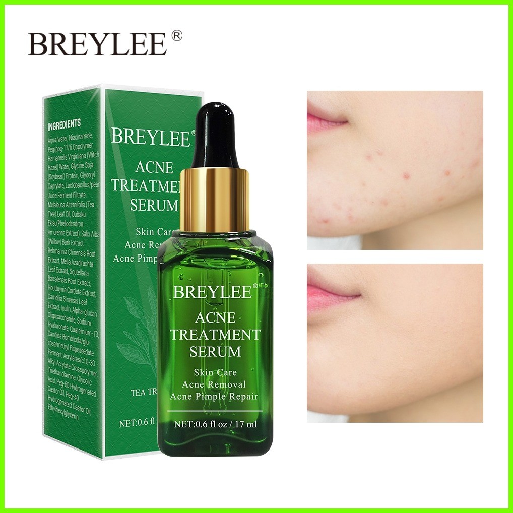 ♂ ۩ BREYLEE Tea Tree Acne Treatment Serum Repair Pimple Mark Control oil Prevent Acne Skincare ...