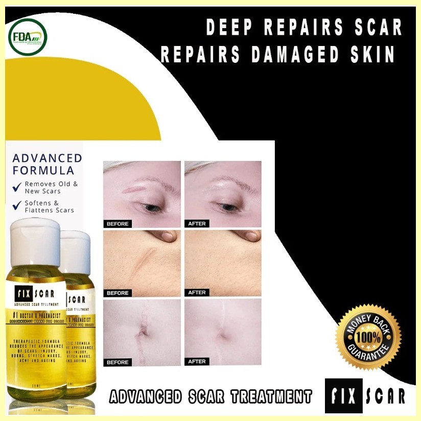 FIXSCAR ADVANCED SCAR TREATMENT (Para sa peklat, Melasma, Keloids ...