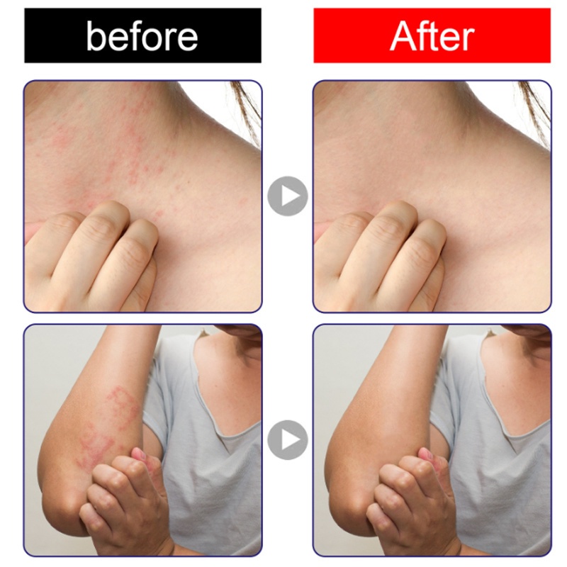 Psoriasis Antibacterial Cream Dermatitis Eczematoid Ointment Effective ...