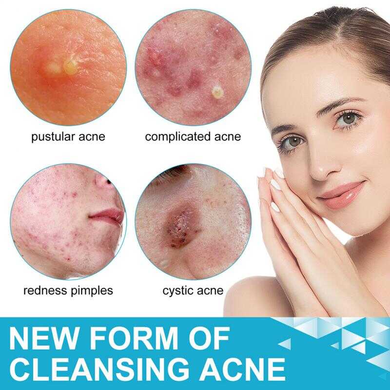 Stickers Acne Stick Acid Pimple Tools Maganda Removal Hyaluronic Patch ...