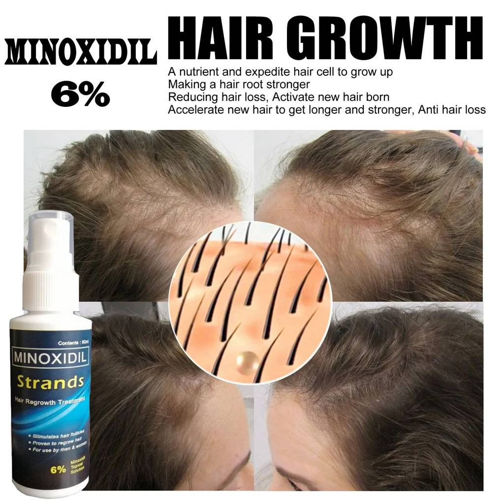 Strands 6% Minoxidil Topical Solution(60ml bottle)Hair beard eyebrow ...