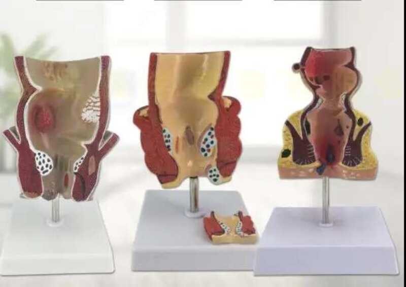 Lesion Rectal Internal And External An Anorectal Colorectal Pathology ...