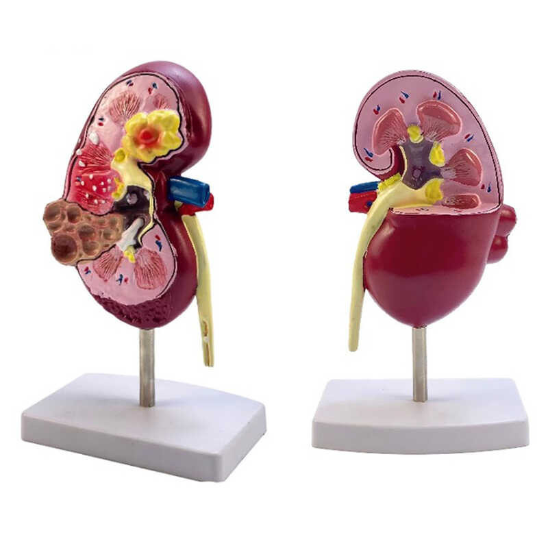 1 Pcs Life Size Kidney Pathologies Model Human Body Anatomy Replica Of ...