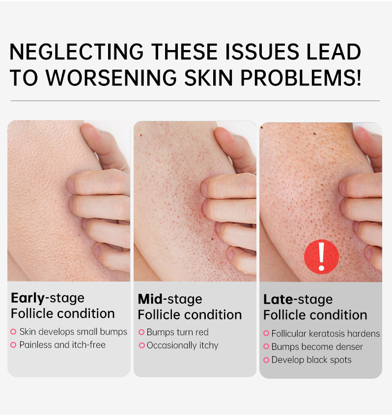Body Cream Chicken Skin Removal Treatment Keratosis Pilaris Lotion ...